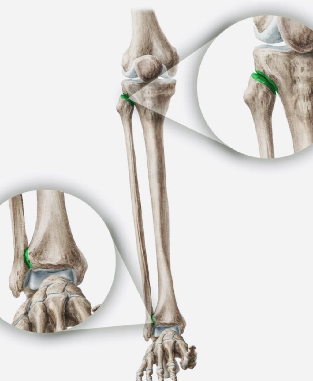 A Pain In The Head Of The Fibula