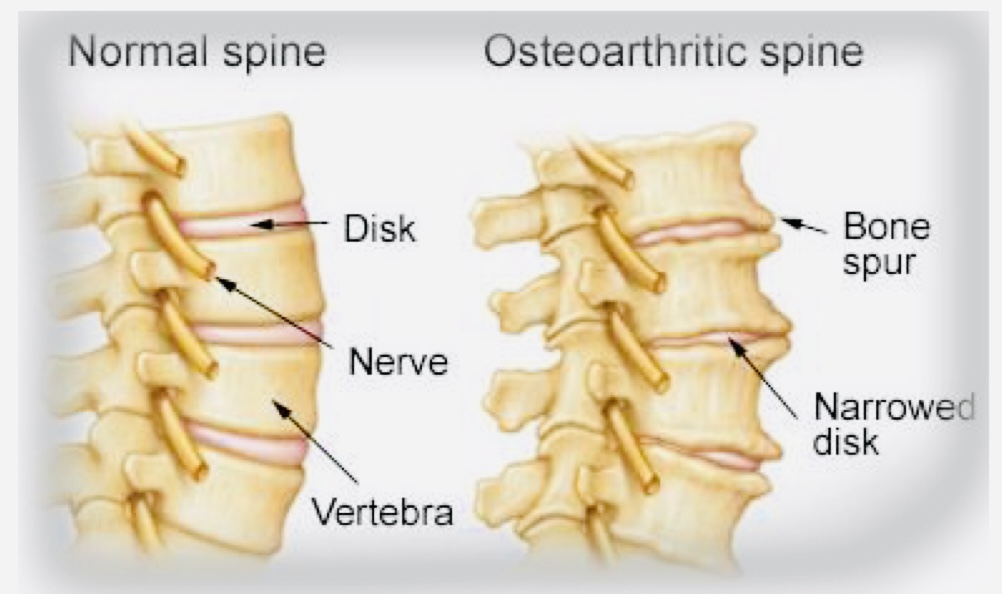 Degenerative Disc Disease NHS